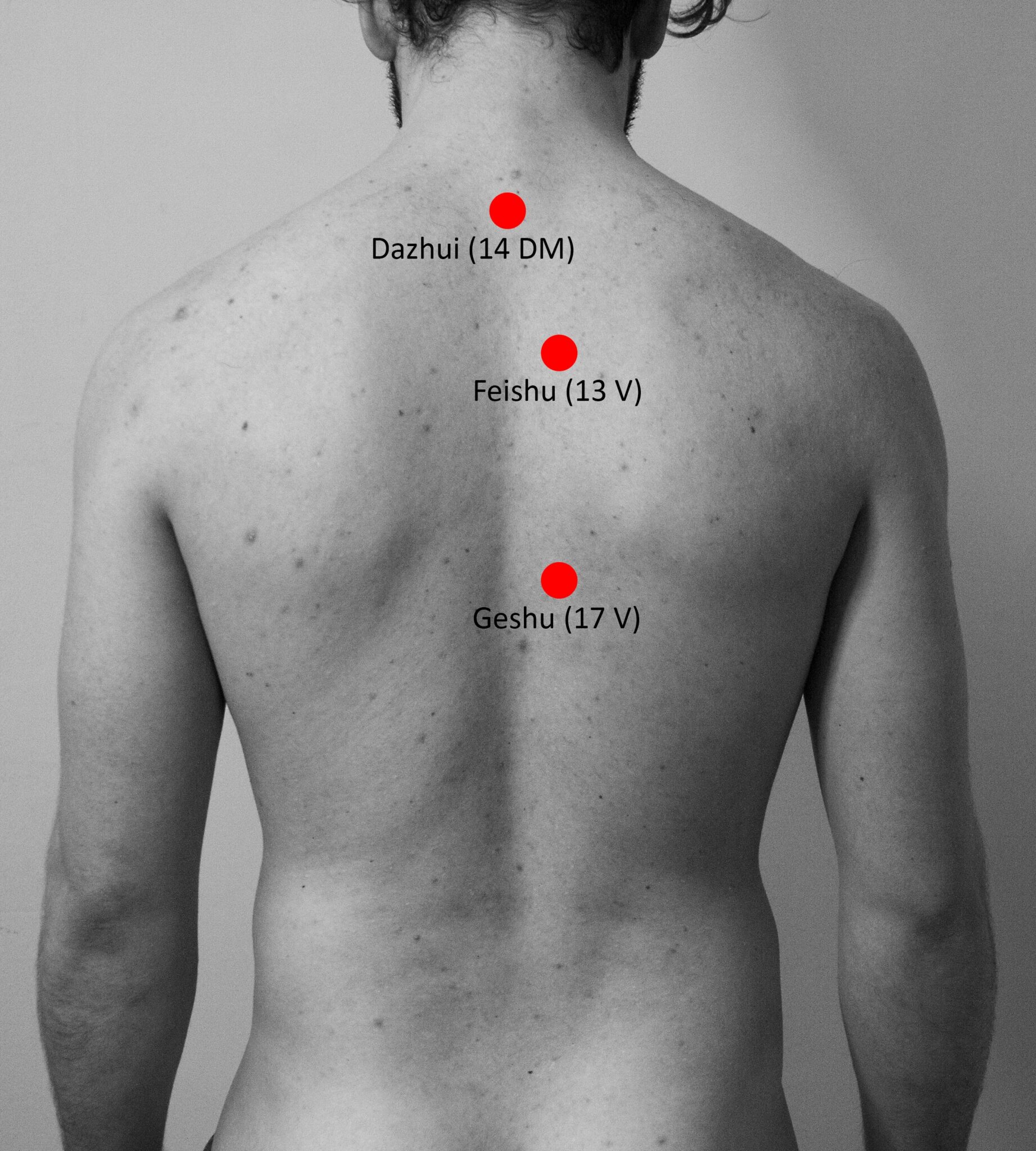 4.Dazhui(14DM)Feishu(13V)Geshu(17V)Moxibustion1 - Escuela Li Ping de ...